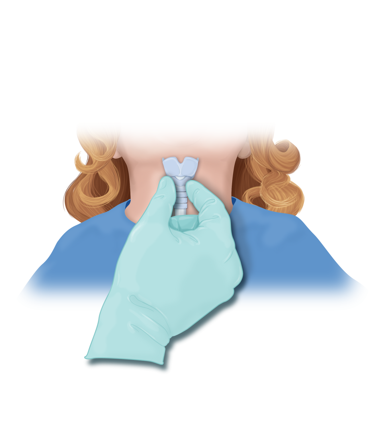 Under Pressure: The Application of Cricoid Pressure in Pediatrics ...