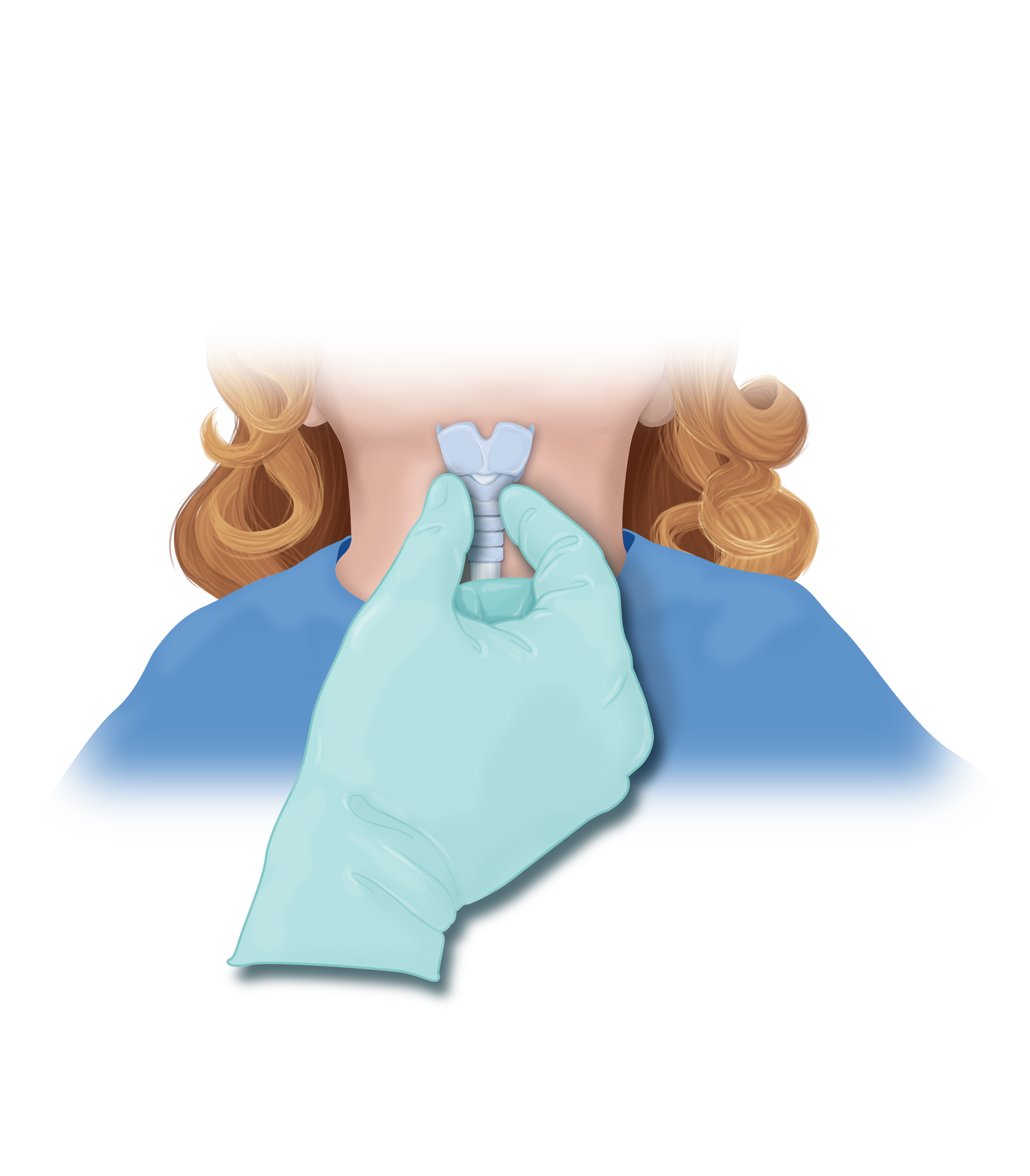 Under Pressure: The Application of Cricoid Pressure in Pediatrics ...