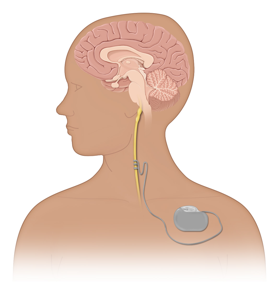 Vagus Nerve Stimulation Can Have Positive Health Benefits