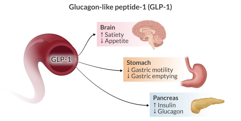 GLP-1 and Anesthesia: Considerations and Cautions for CRNAs